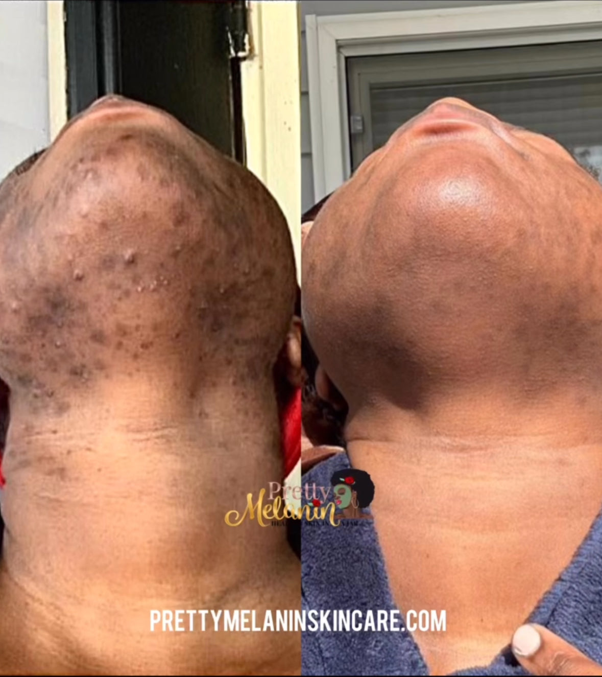 Pretty Melanin Skincare – prettymelaninskincare