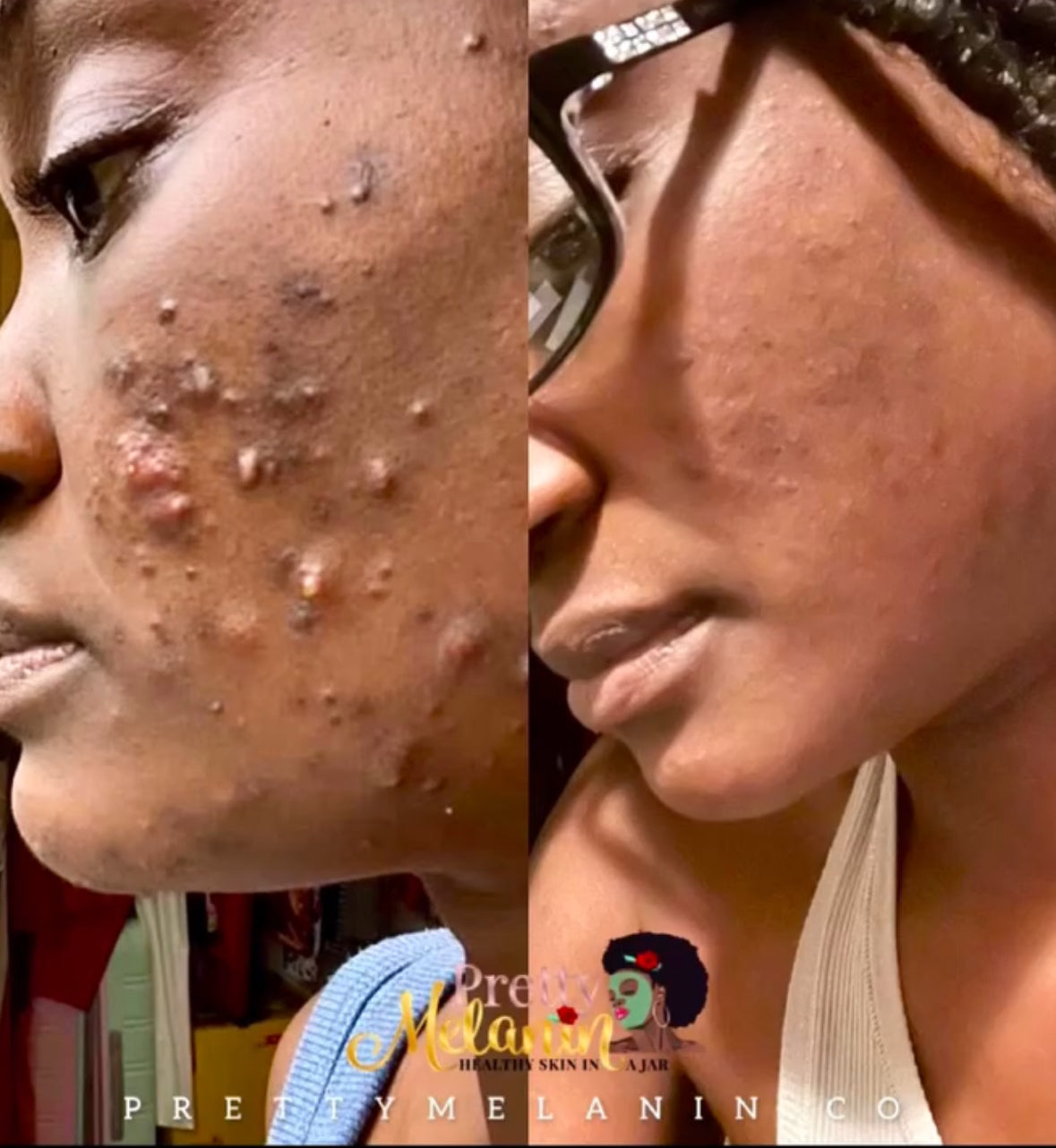 Pretty Melanin Skincare – prettymelaninskincare