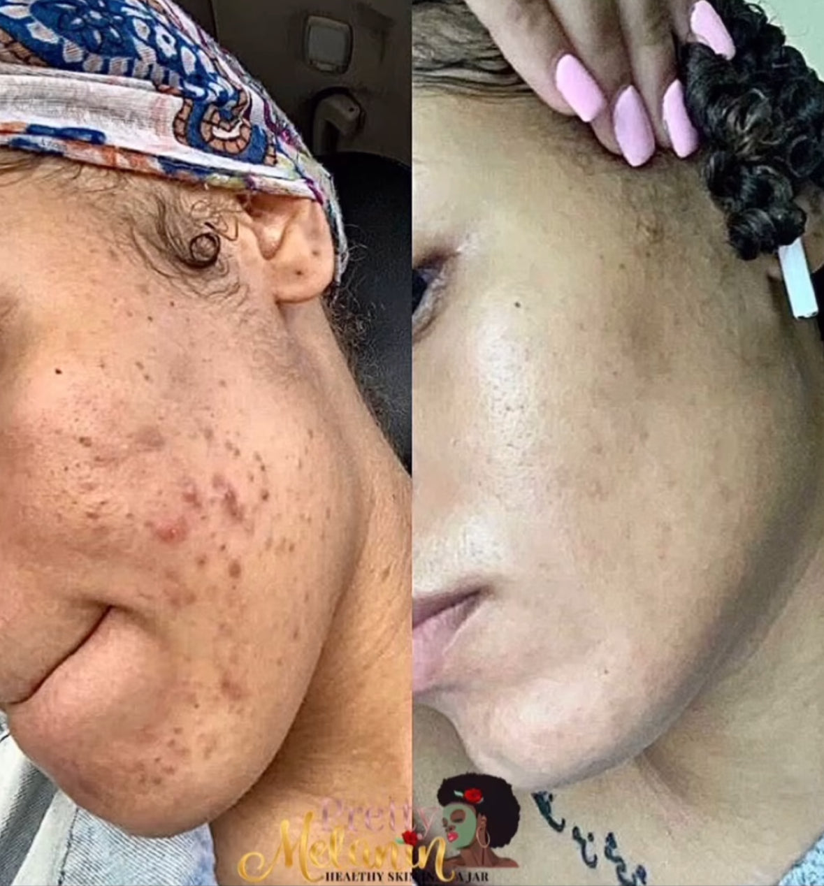 Pretty Melanin Skincare – prettymelaninskincare