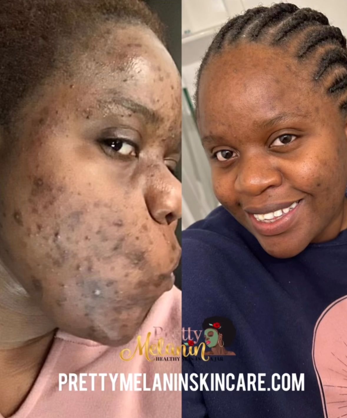 Pretty Melanin Skincare – prettymelaninskincare