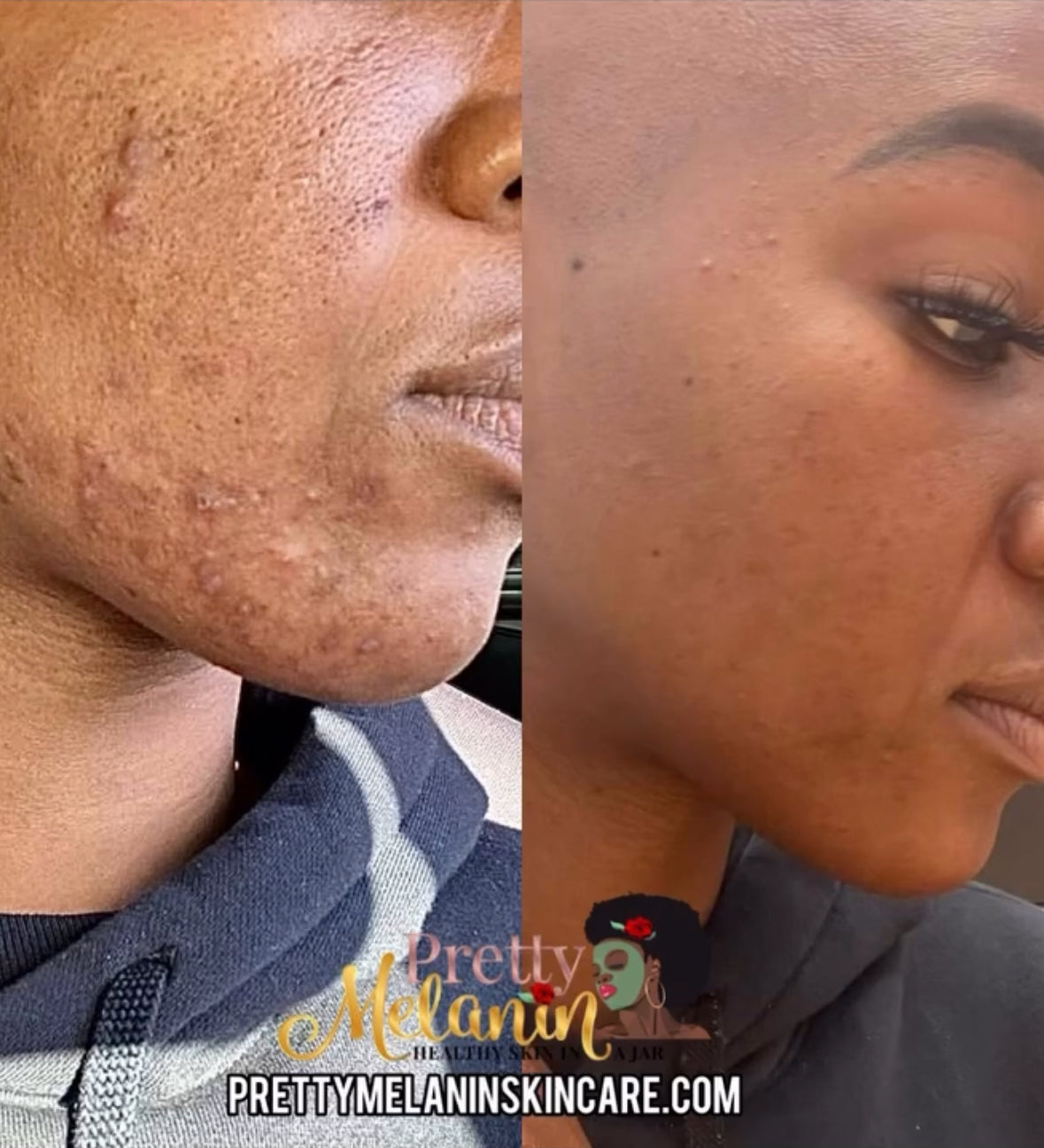 Pretty Melanin Skincare – prettymelaninskincare