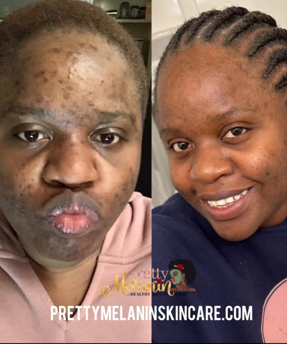 Pretty Melanin Skincare – prettymelaninskincare
