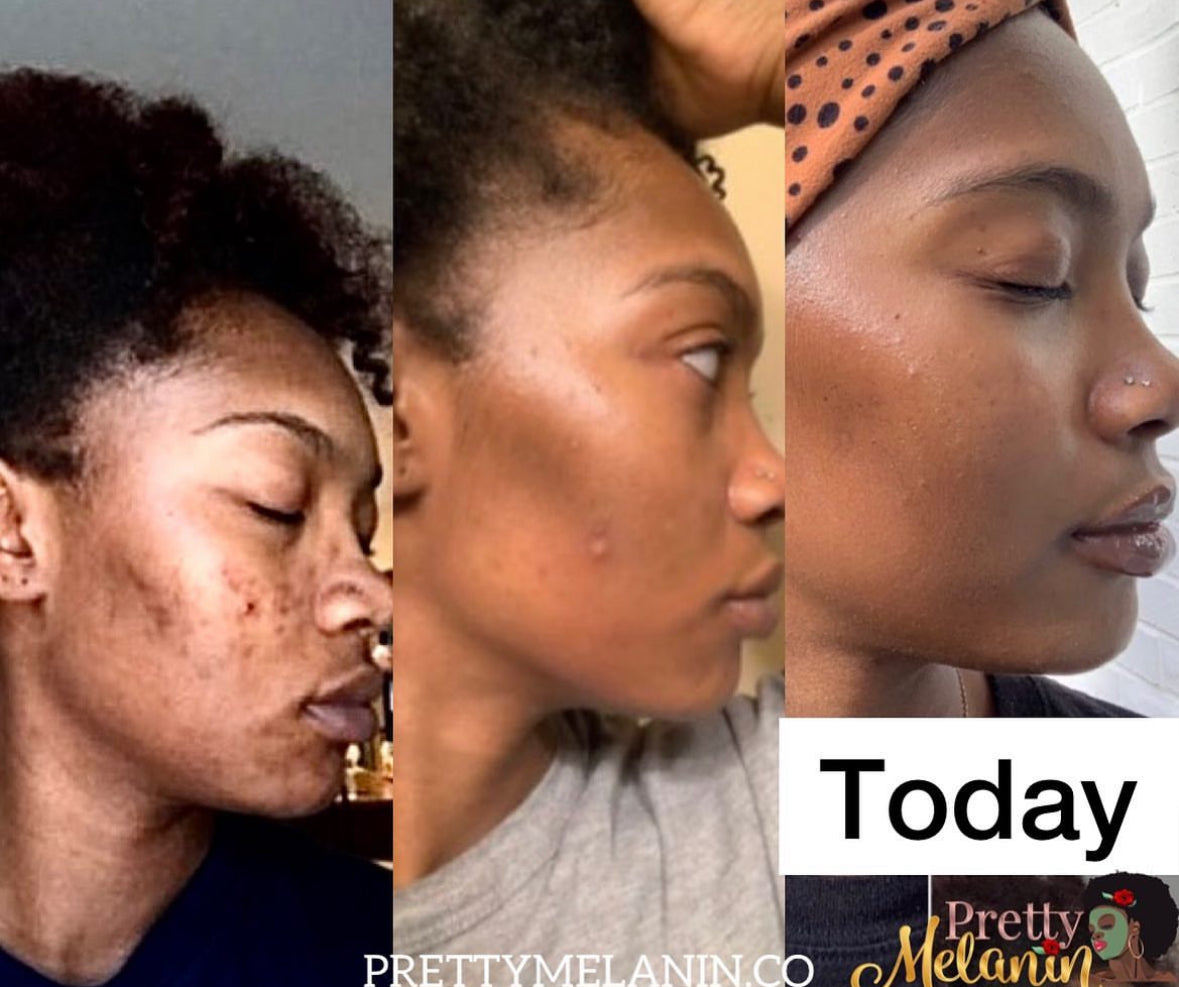 Pretty Melanin Skincare – prettymelaninskincare
