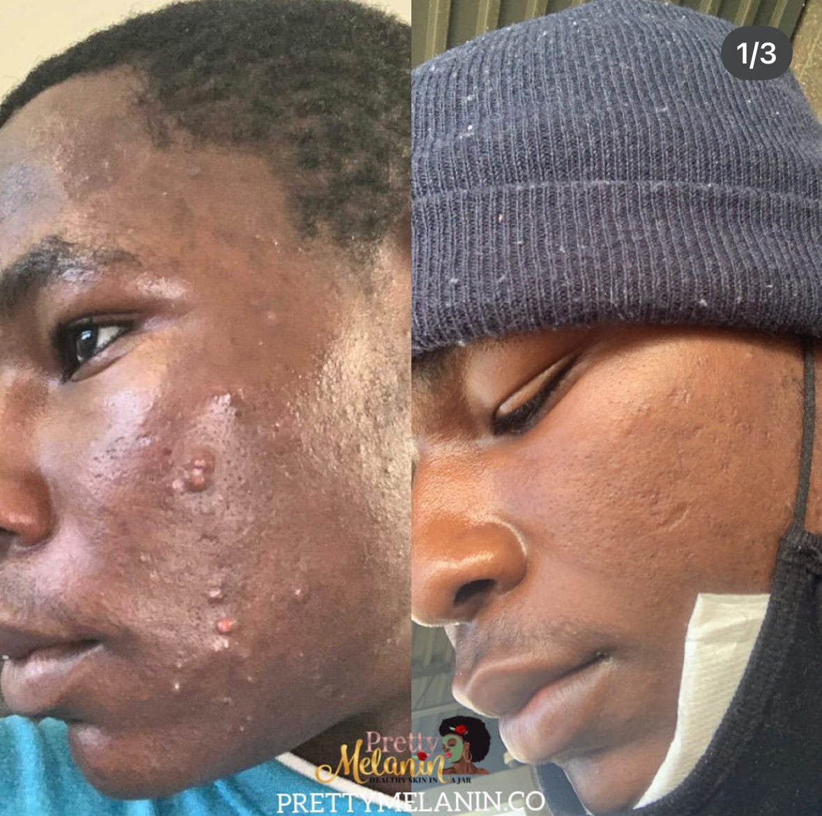 Pretty Melanin Skincare – prettymelaninskincare