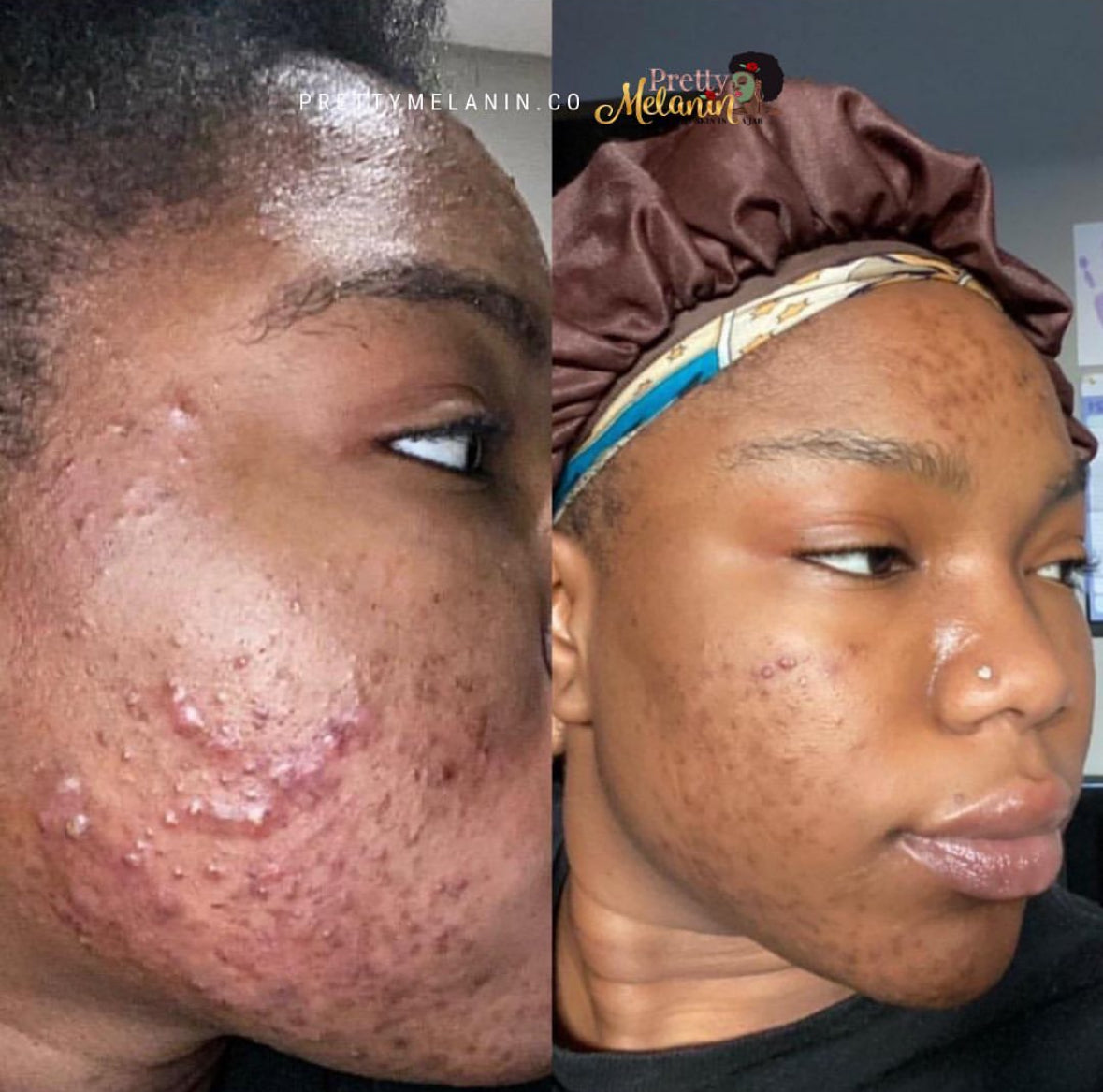 Pretty Melanin Skincare – prettymelaninskincare